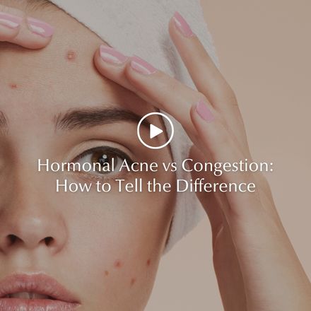Hormonal Acne vs Congested Skin: How to Identify & Treat Breakouts